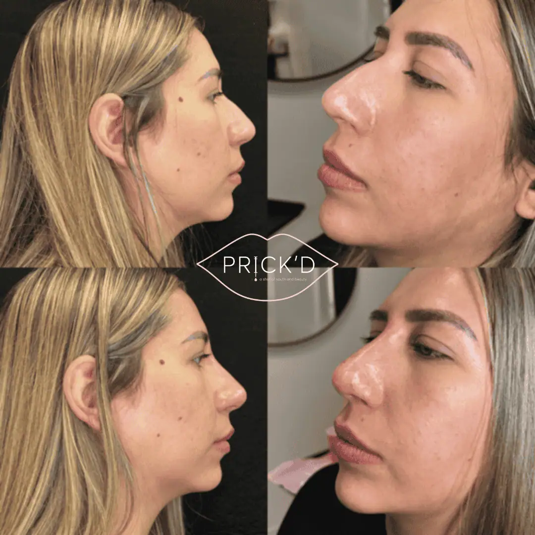 Non-Surgical Nose Job Treatment in St Louis | Smooth Nose Lines